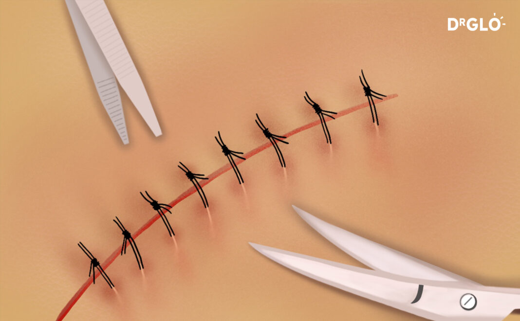 Scar Management - Wound Care After Suture Removal - Dr. Glo - Protect ...